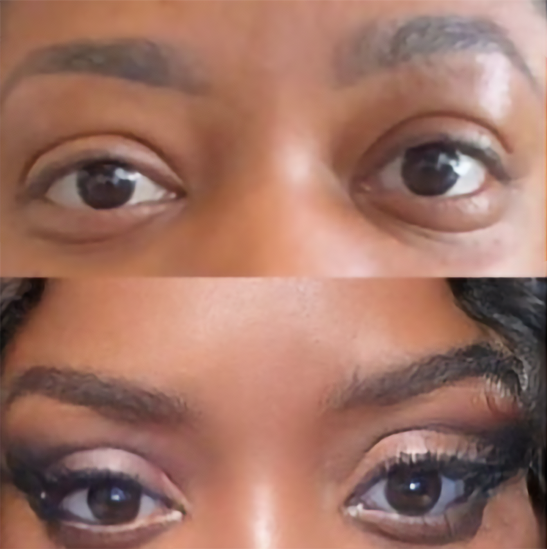 Blepharoplasty - Dr. Murat Sağdık